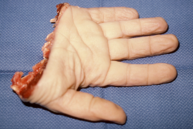 AMPUTACIÓN DE MANO | Recurso de cirugía de mano